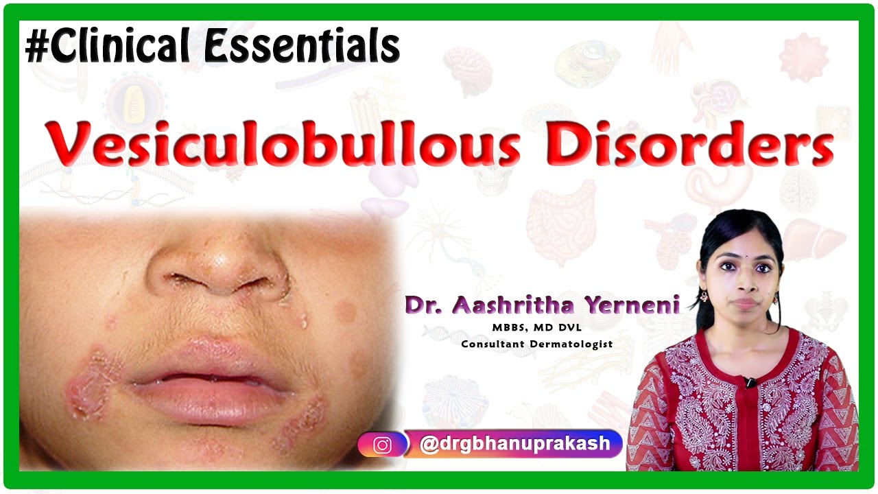 Vesiculobullous disorders (Clinical essentials): Dr. Aashritha yerneni ...