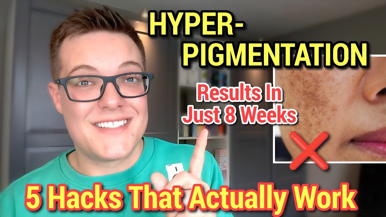 HYPERPIGMENTATION - 5 Hacks To Fade Dark Spots FAST - YouTube