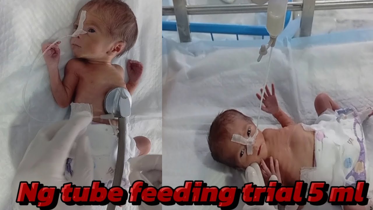 Pass NG Tube Procedure | 5ml NG Tube Feeding in NICU | Neonatal Care ...