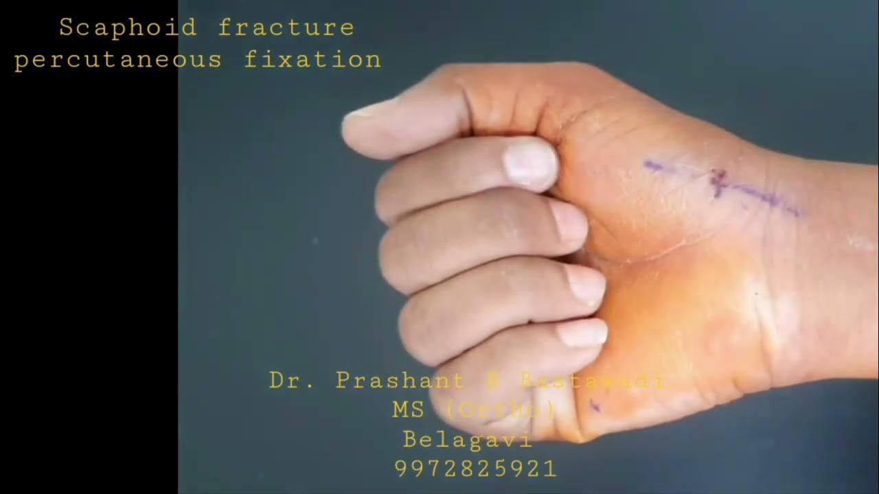 Scaphoid Bone Fracture Percutaneous Herbert Screw Fixation Dr