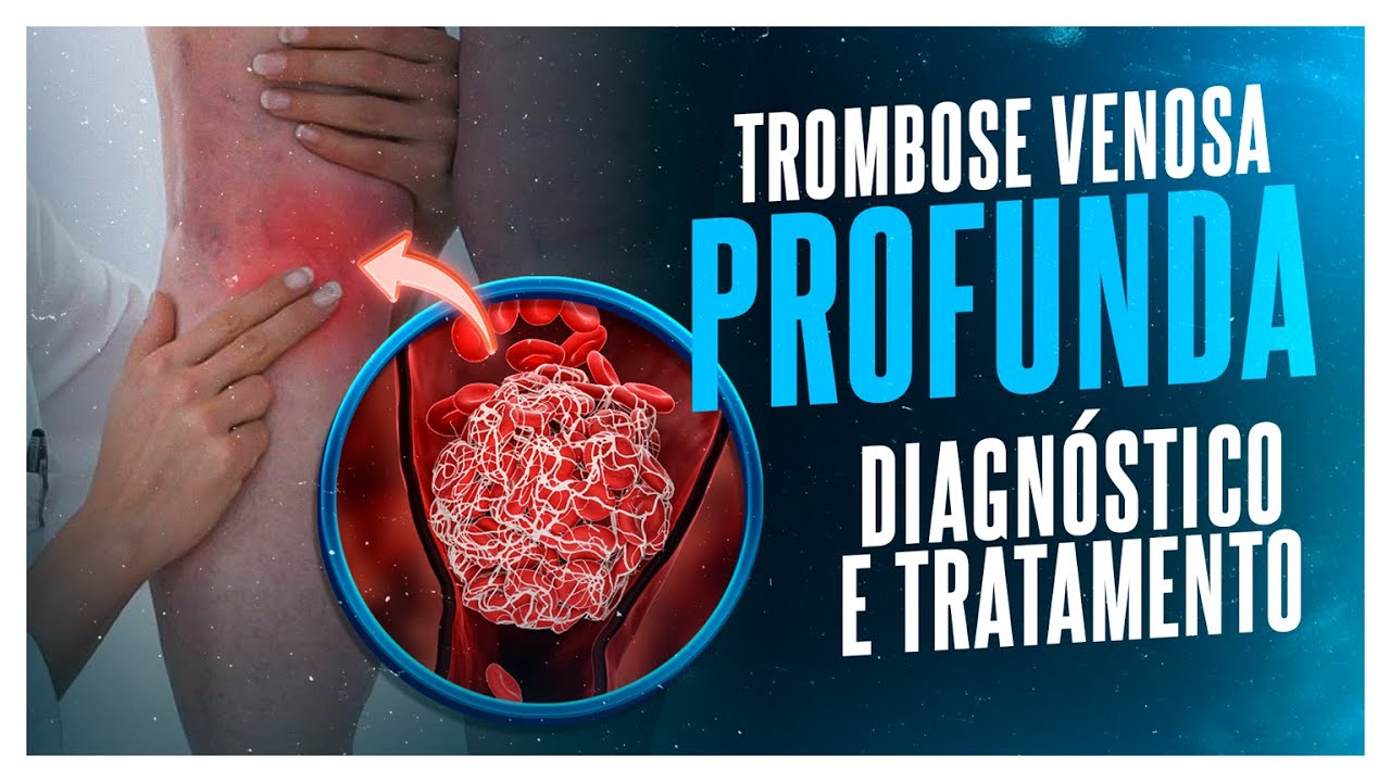 TROMBOSE VENOSA PROFUNDA - DIAGNÓSTICO E TRATAMENTO - YouTube