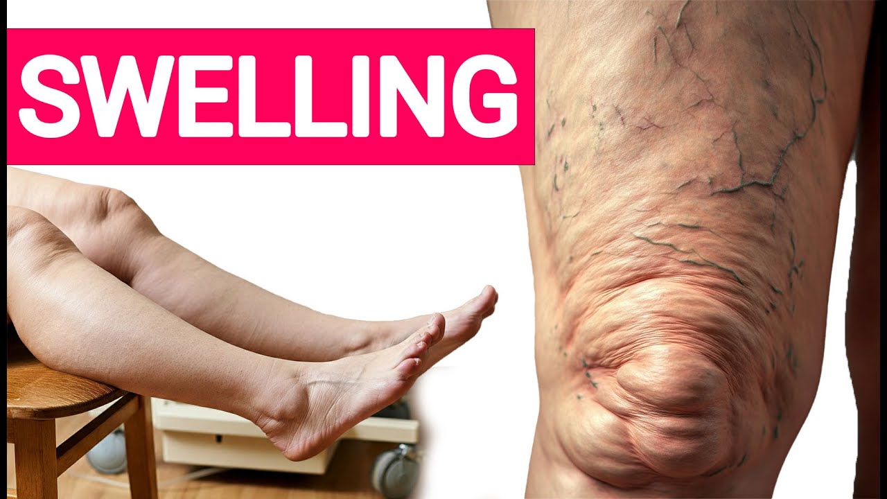 7 Surprising Causes of Swollen Legs You Must Know! 🚨👣 - YouTube
