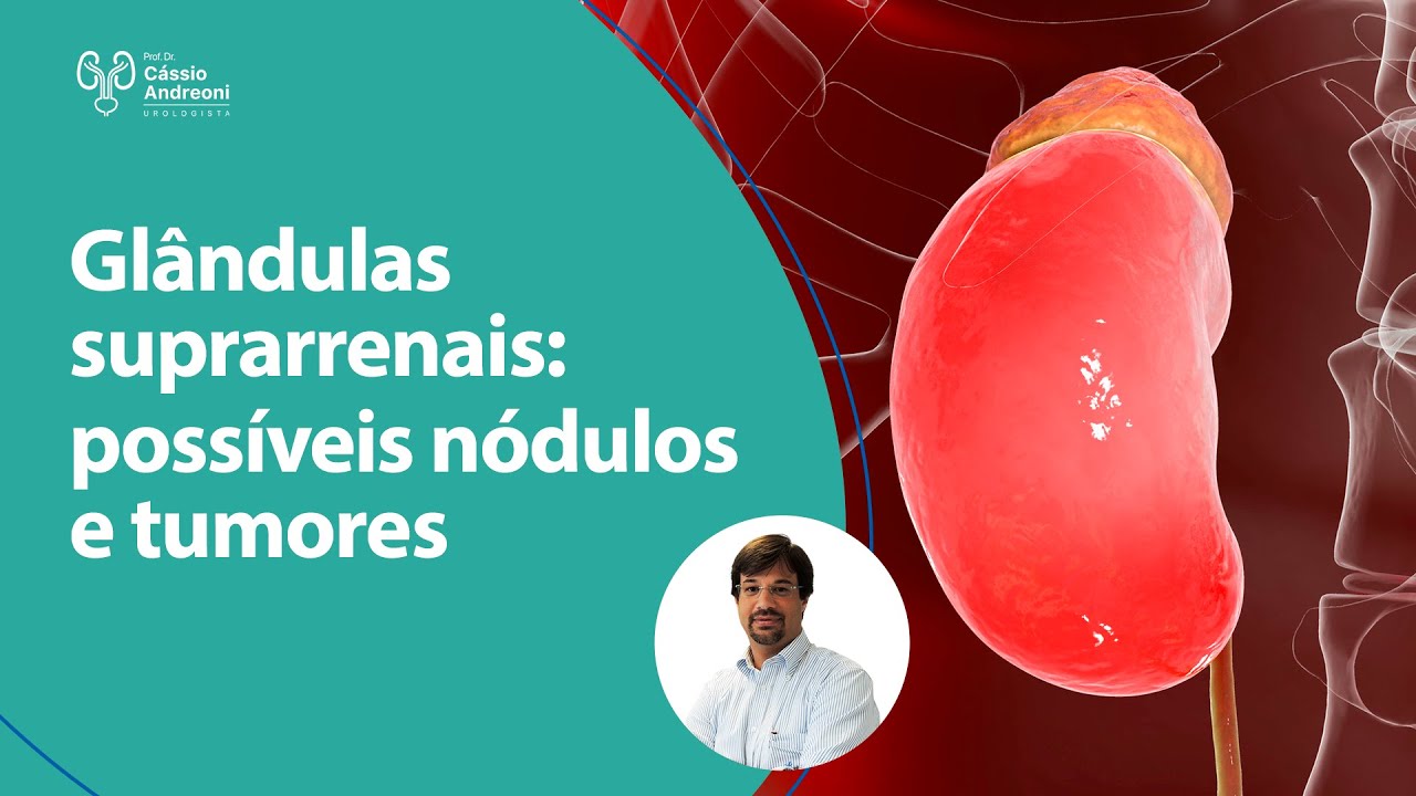 Glândulas suprarrenais: possíveis nódulos e tumores | Dr. Cassio ...