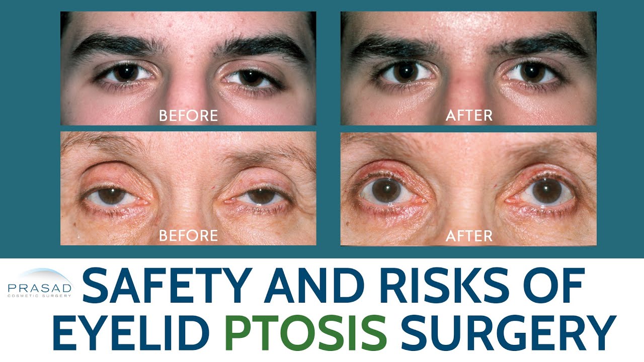 Ptosis Surgery Risks and Safety - What You Need to Know - YouTube
