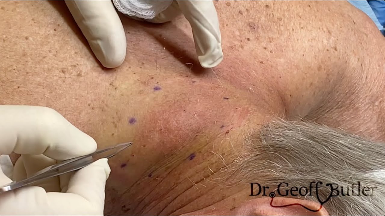 Removal of a lipoma at the base of the neck - YouTube