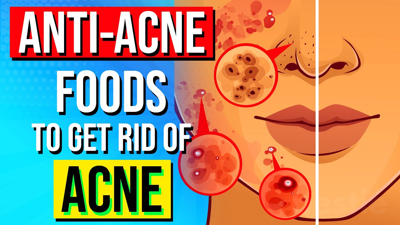 17 ANTI-ACNE Foods You Must Eat To Get Rid Of Acne & Scars - YouTube