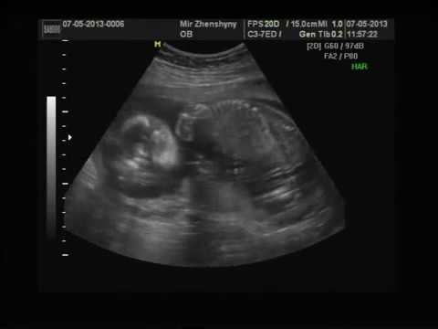 Erkek Bebek Ultrason Görüntüsü - Bebek Cinsiyet Tahmini