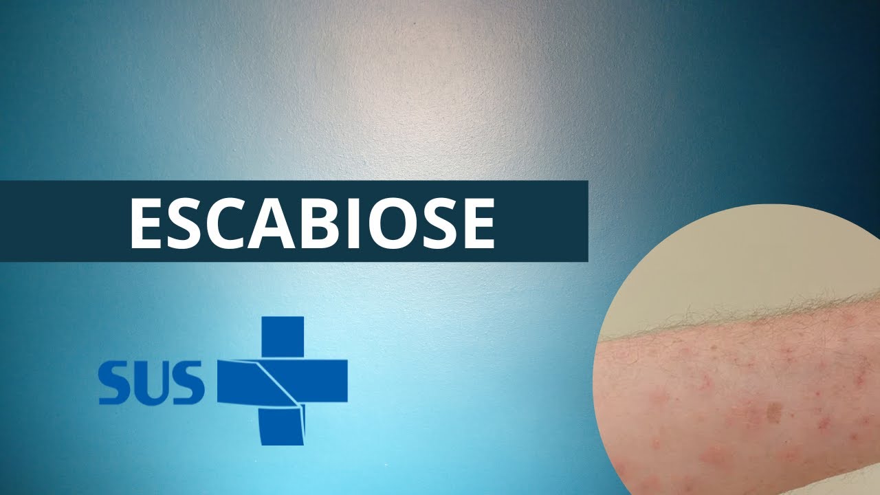 Escabiose (Sarna) - tudo o que você precisa saber! - YouTube