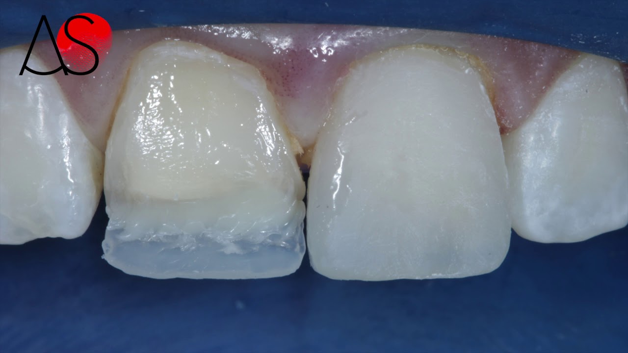 Restauração Com Resina Composta Passo A Passo - RETOEDU