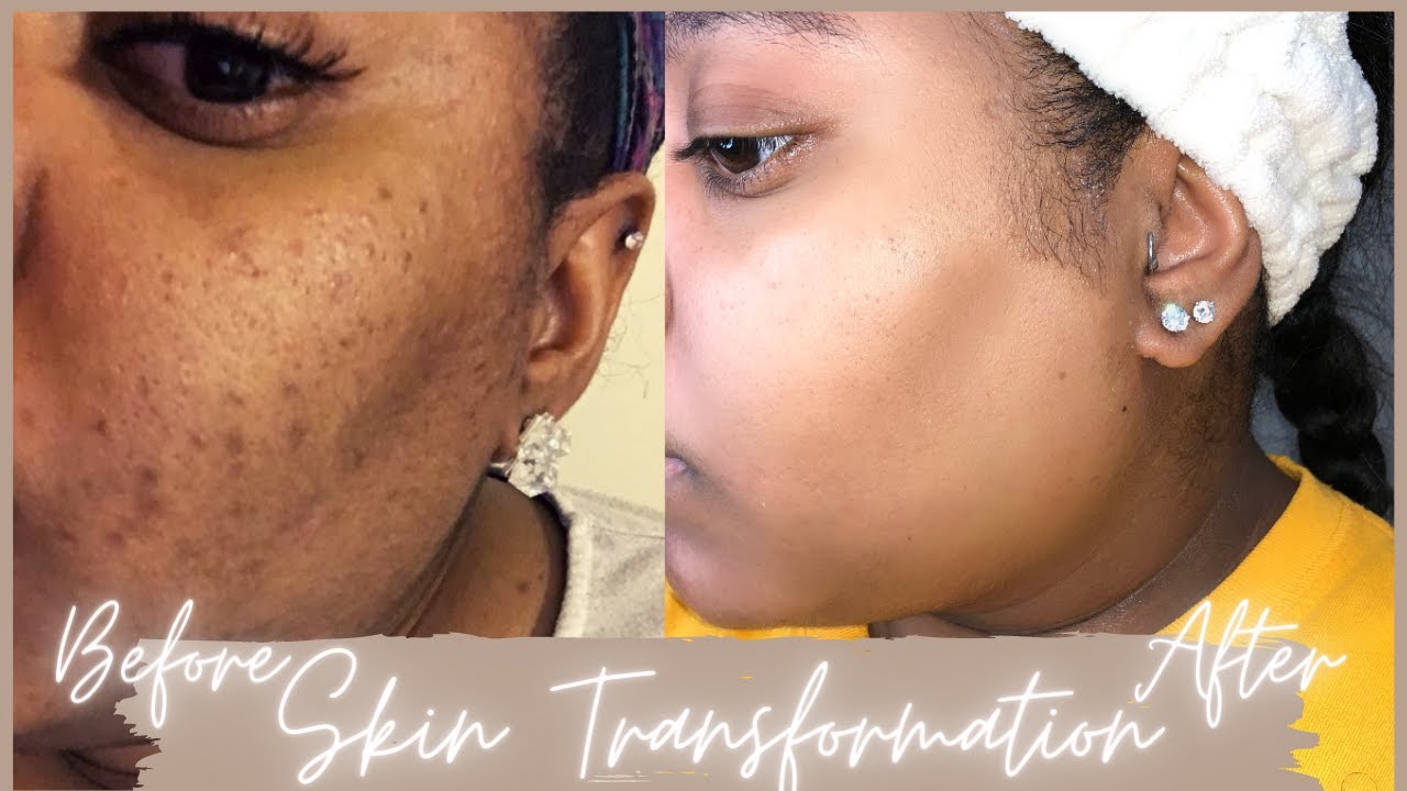 How to Get Rid of Dark Spots | My Skin Transformation | $20 Skin Care ...
