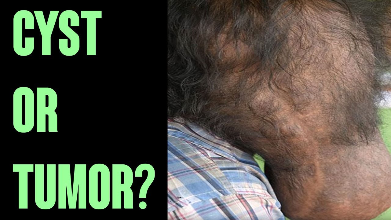 20-Pound Cyst? Cambodian Man's Growth - YouTube