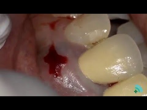 Abscess-Cyst-Acne Extraction | Incision and Dainage of Root Canal ...