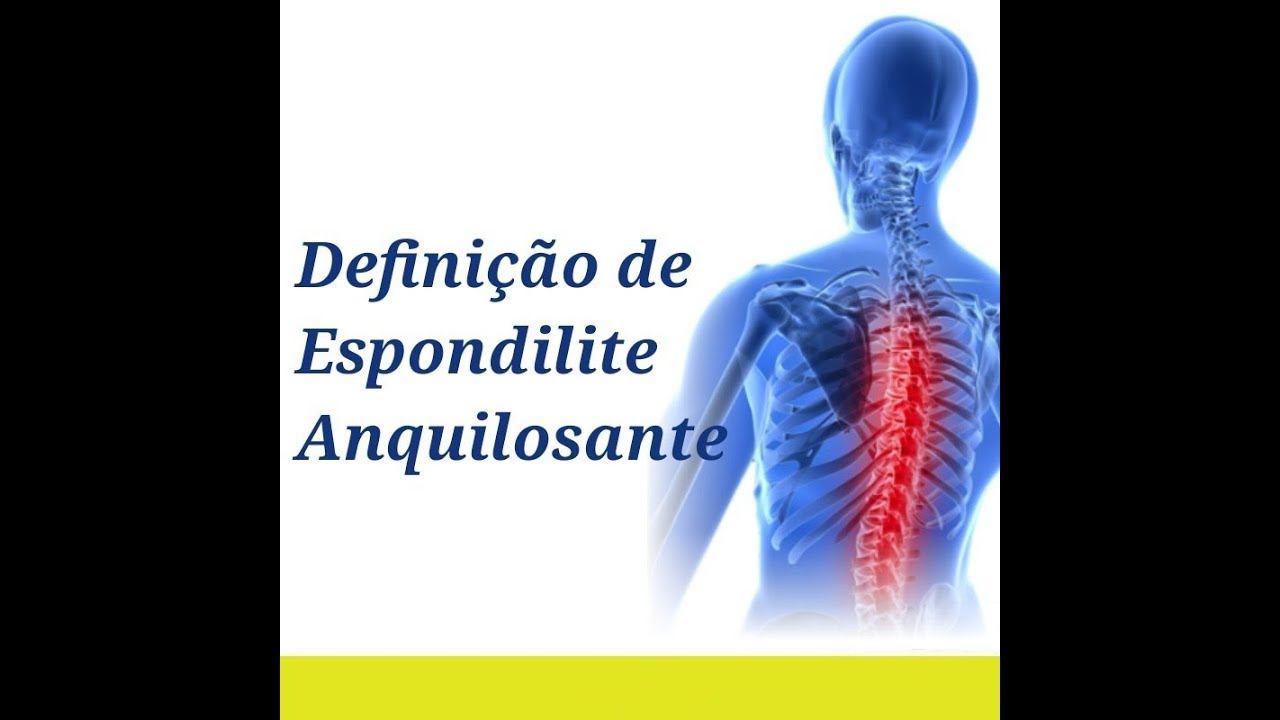 ESPONDILITE ANQUILOSANTE Doença Inflamatória Crônica da Coluna Clínica ...