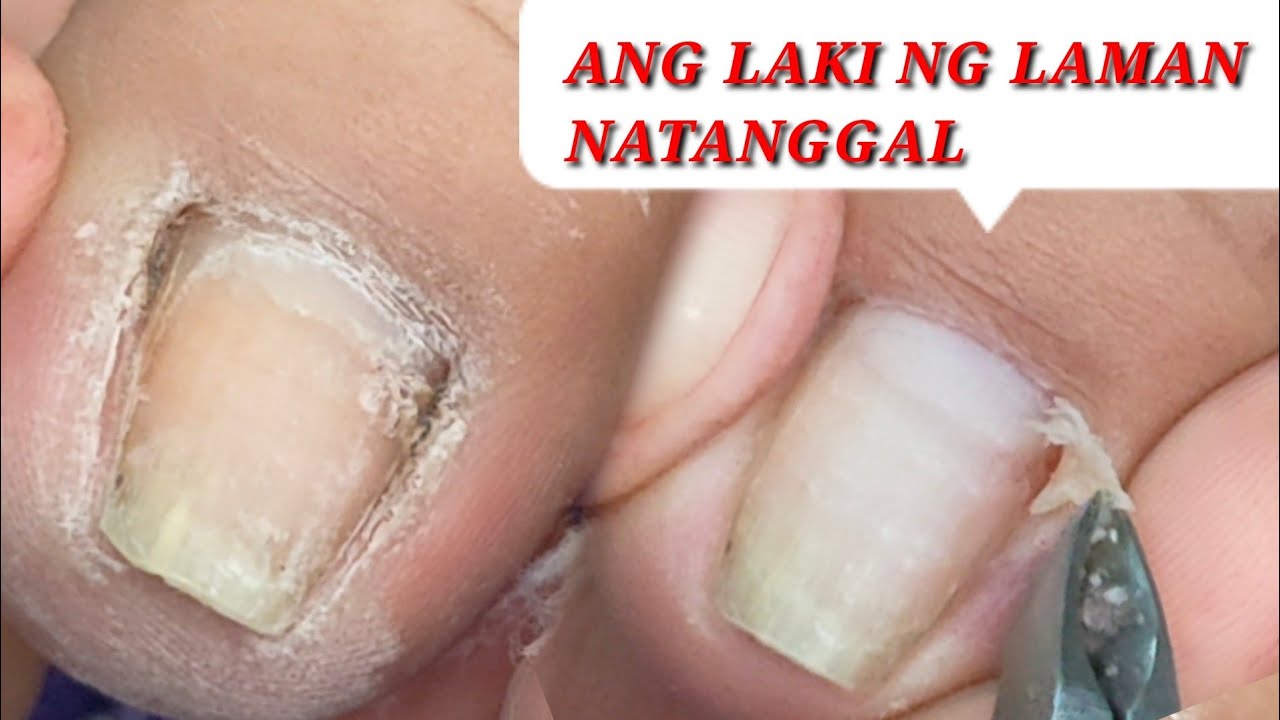 Bilateral Ingrown Toenail Removal-ODDLY SATISFYING - YouTube