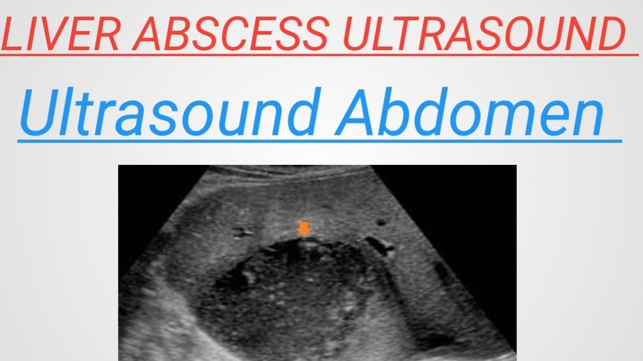 Ultrasound showing Liver Abscess!Liver Ultrasound! Ultrasound Abdomen ...