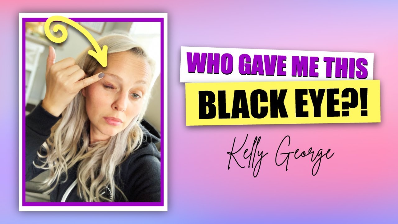 BLACK EYE, Multiple Sclerosis (Bruising post Lemtrada?) - YouTube