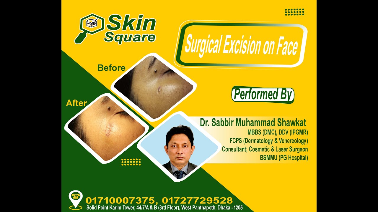 Surgical Excision on Face || Dr. Sabbir Muhammad Shawkat || Skin Square ...