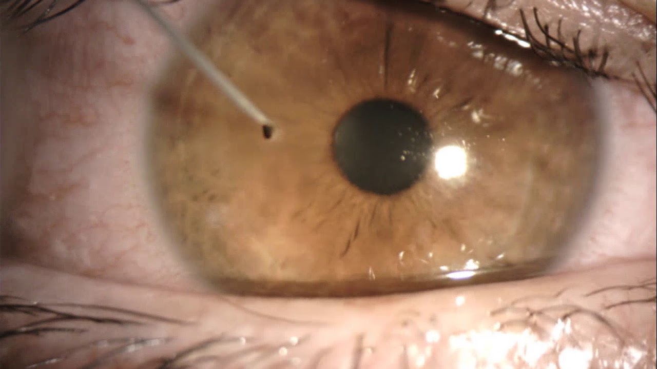 Foreign Body In Eye