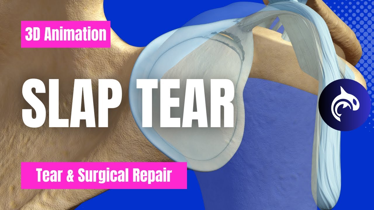 SLAP Tear and Repair - 3D Animation (No Narration) - YouTube