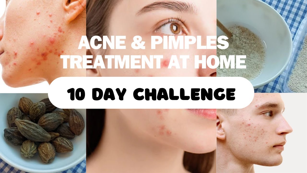 Acne & Pimples Treatment At Home (The Best Medicine and Face Packs for ...