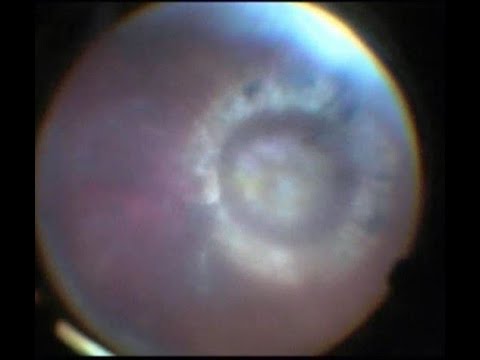 Chapter 24: Vitrectomy for PVR detachment secondary to morning glory ...