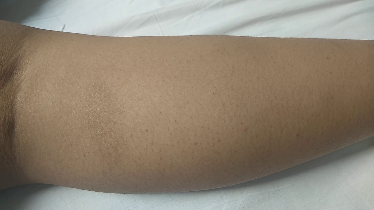 Neuromyotonia in morvan syndrome - YouTube