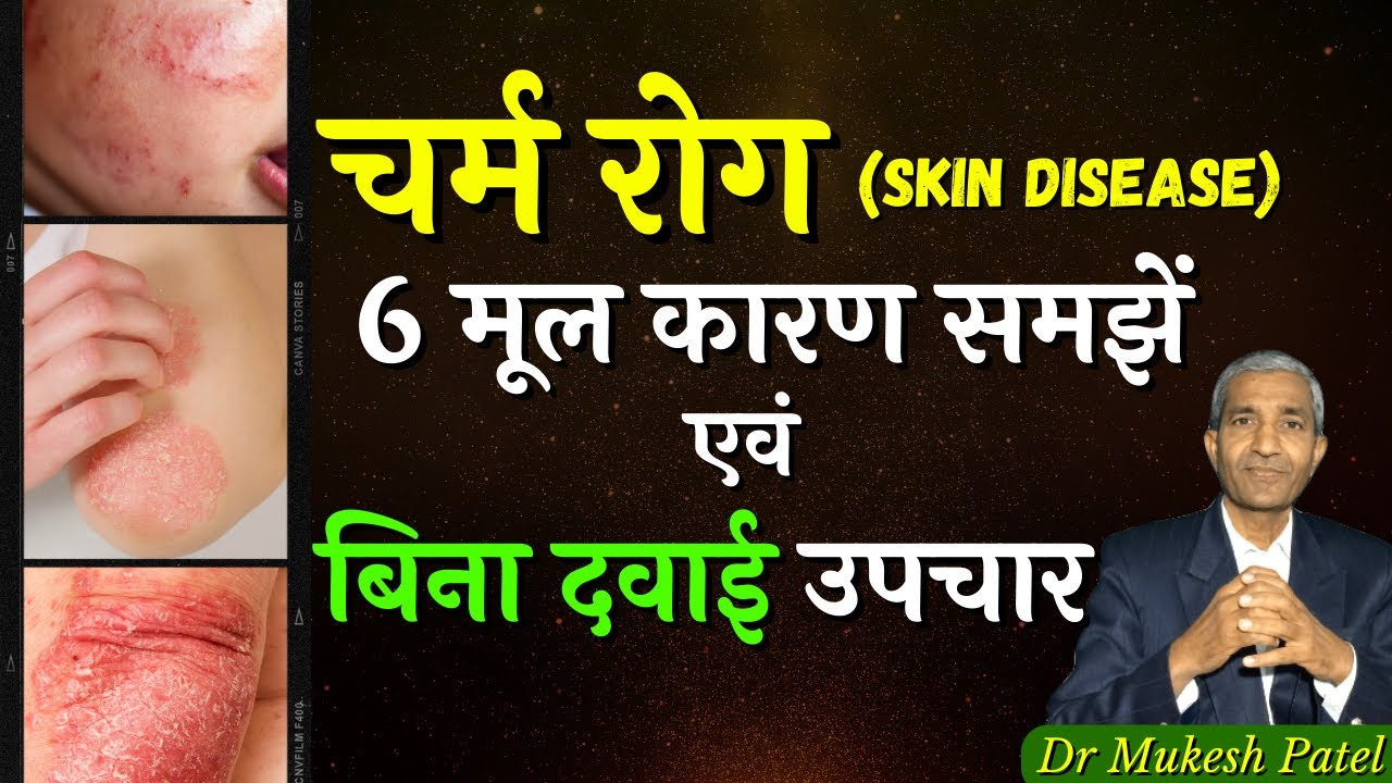 चर्म रोग(Skin Disease) बिना दवाई ठीक करें | Charm Rog Ka ilaj ...