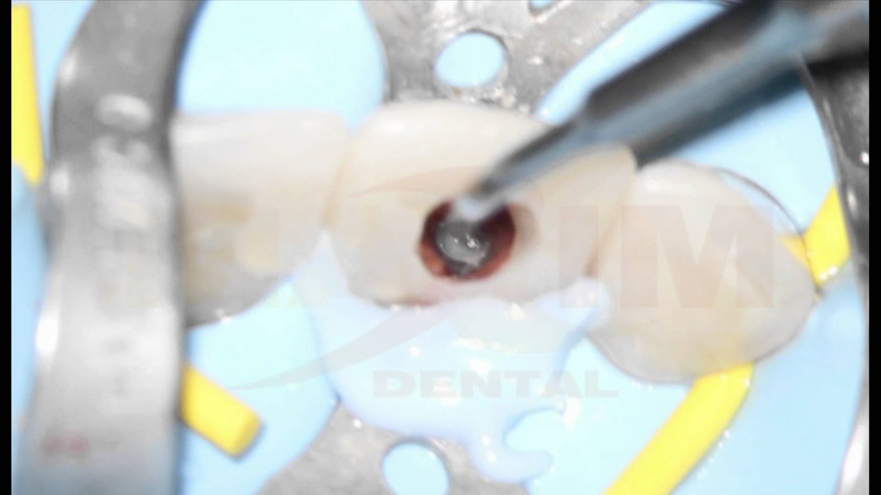 Broken Instrument Removal - YouTube