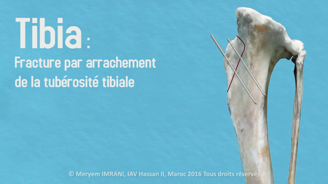 Chirurgie vétérinaire - Haubanage - YouTube