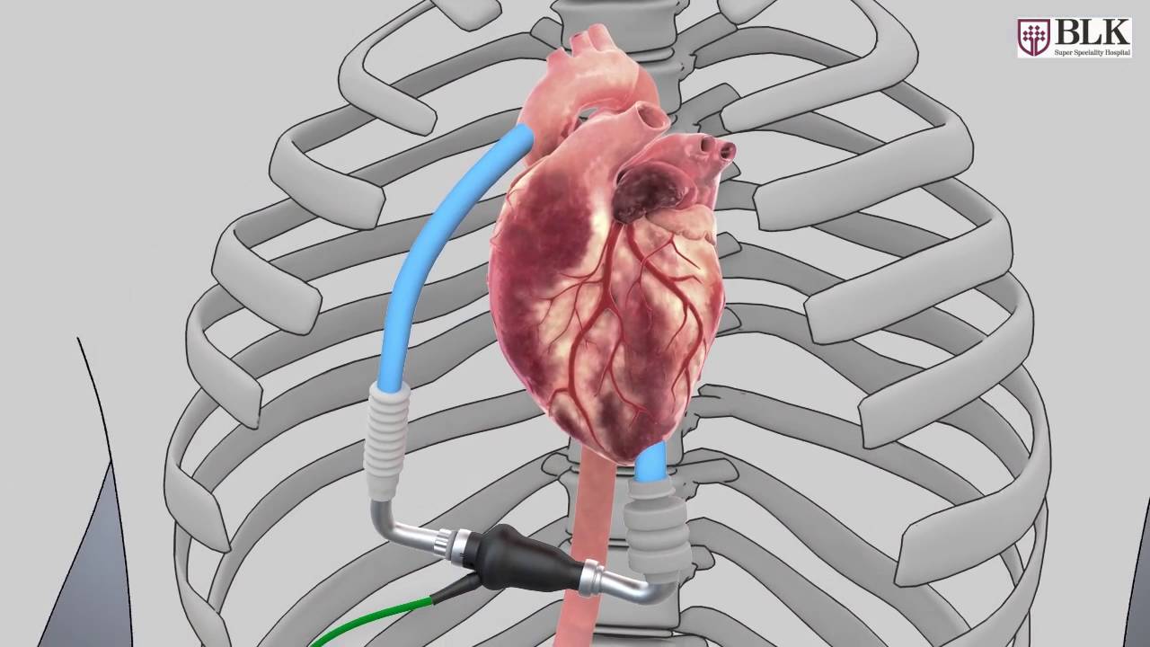MedAni BLK LVAD - YouTube