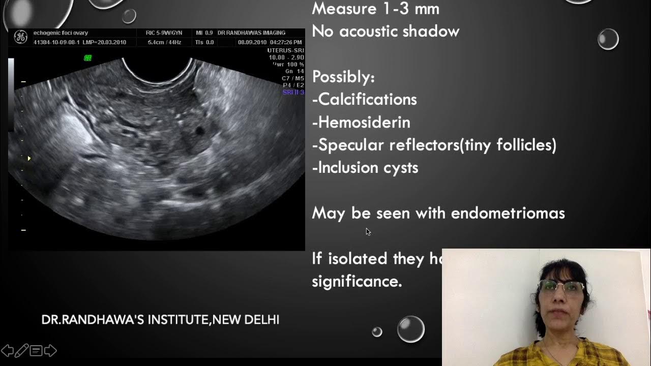 ultrasound-tvs-echogenic-foci-in-the-ovary-signifcant-or-not-youtube
