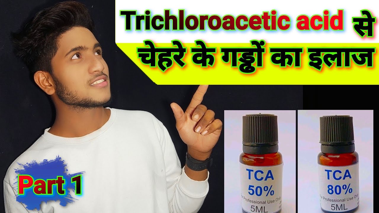 what is tca cross treatment | acne scar removal at home - YouTube