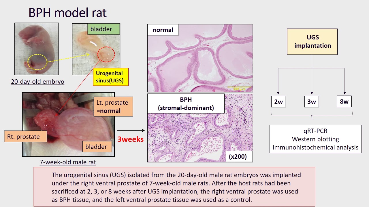 Benign Prostatic Hypertrophy Histology Slide 1: Benign Prostatic