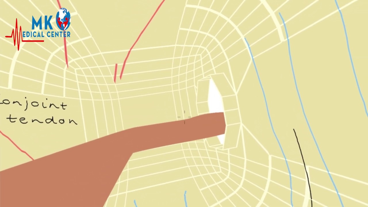 Inguinal hernia anatomy animation - YouTube