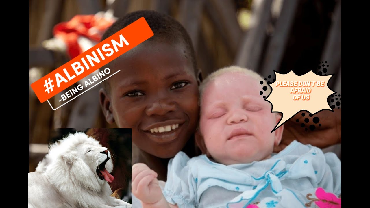 Being Albino The Power of Difference |Fighting Against Prejudice - YouTube