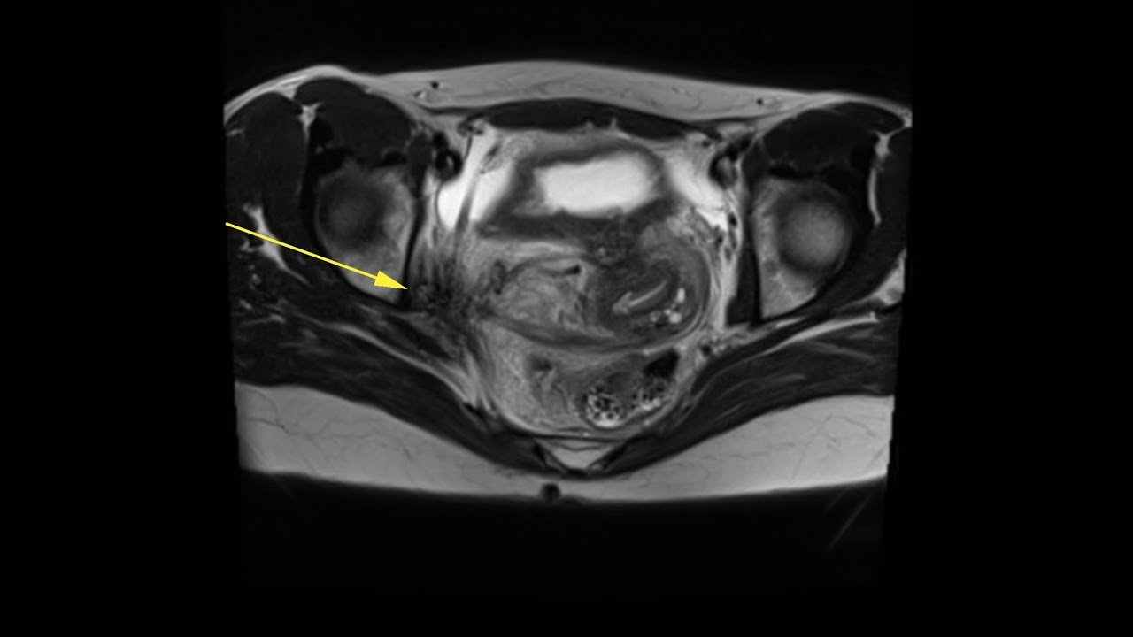 Excision of a large nodule involving the right sciatic nerve: end of ...