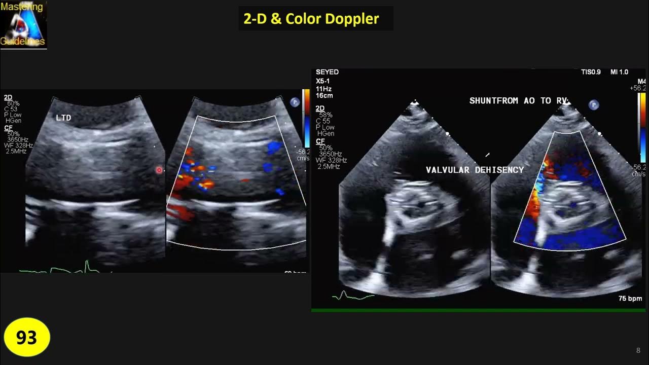 TAVR 1: Echo evaluation - YouTube