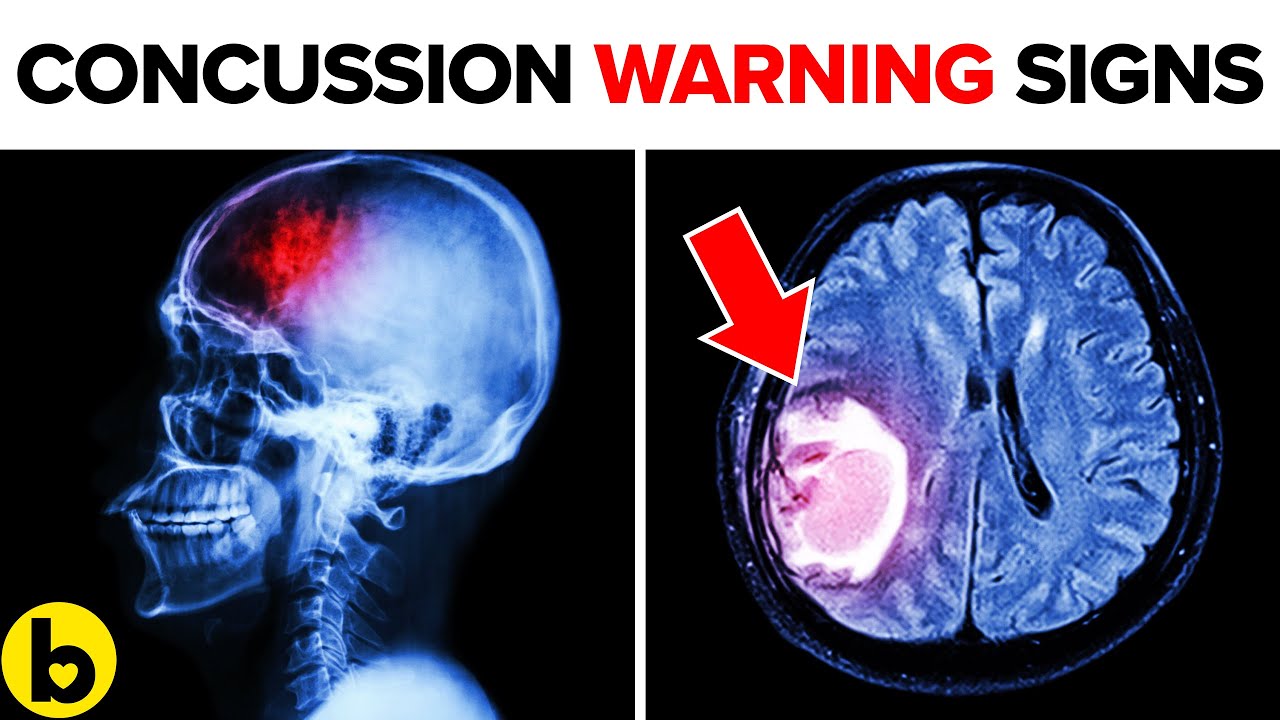 8 Warning Signs That You Have A Concussion - YouTube