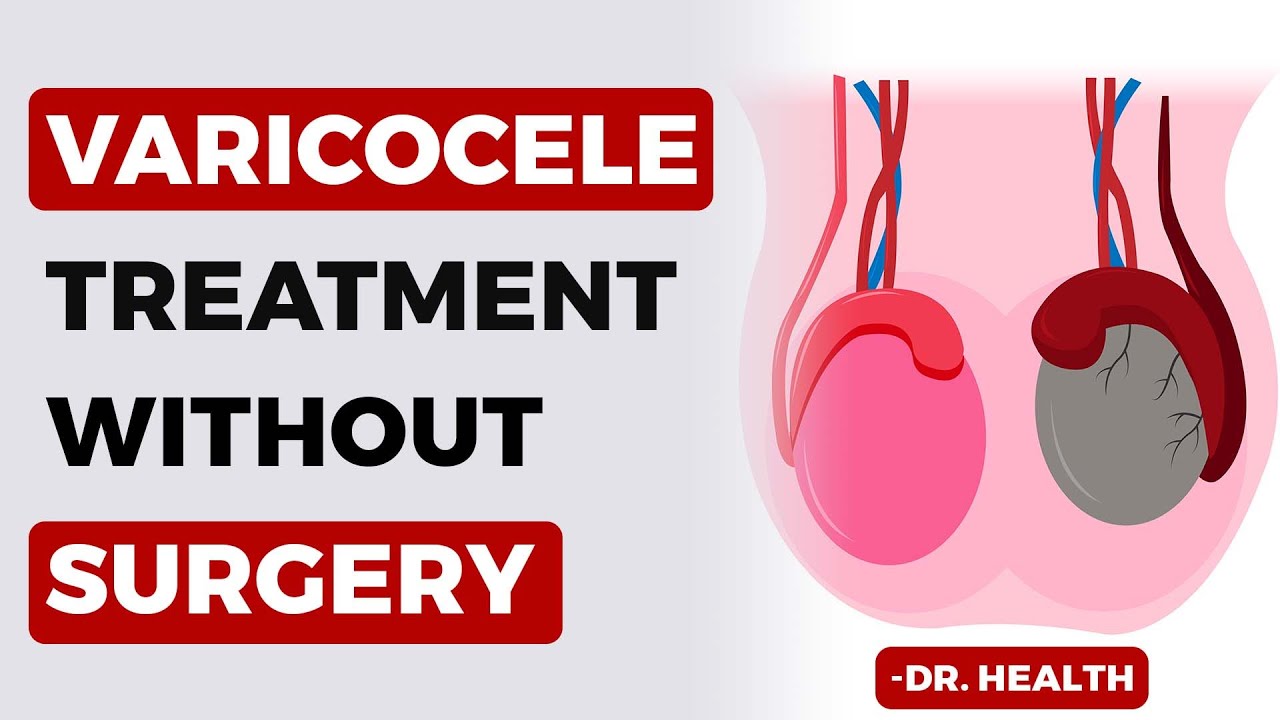 Varicocele Treatment without surgery | Varicocele Natural Treatment ...