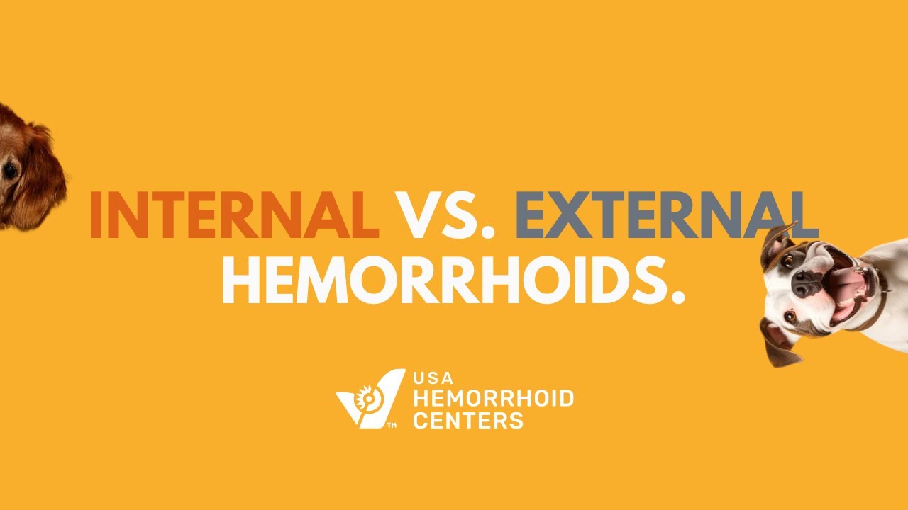 Internal vs. External Hemorrhoids: How to tell the difference. - YouTube