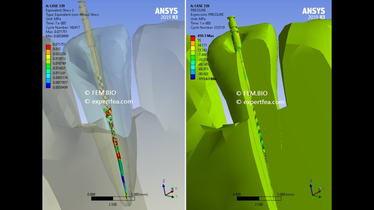 Endodontics or root canal treatment on an incisor with pulp removal ...
