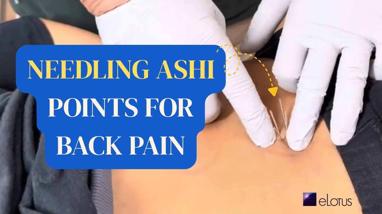 Fast and Quick Ashi Points for Back Pain with Kai-Fong Tiu - YouTube
