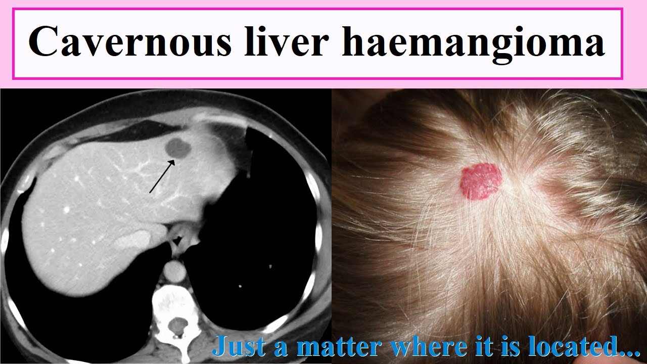 cavernous liver haemangioma - YouTube