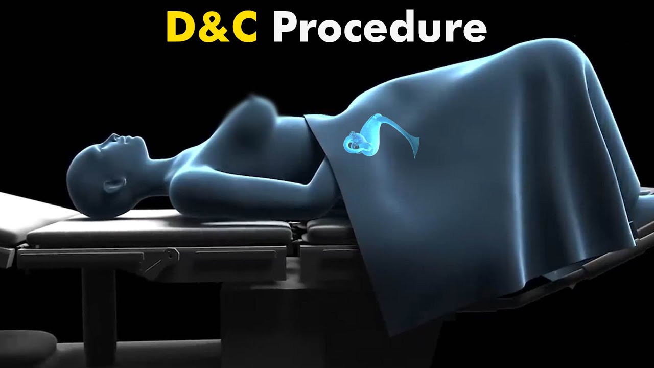 How is D&C Performed? Purpose, Process, and Risks - YouTube