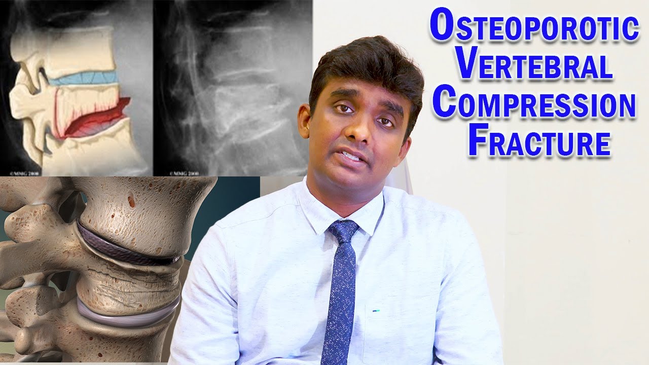 Osteoporotic Vertebral Compression Fracture - Dr. Vijayaraghavan - YouTube
