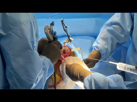 Lateral UKR - Partial Knee Replacement (Journey Uni) using the CORI ...