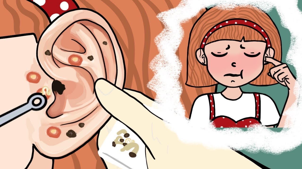 ASMR Clean the ears, remove sebum and blackheads in the ears ...