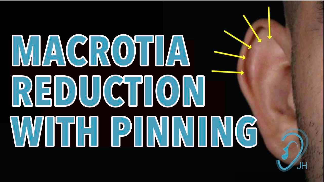 Pinning Effect of Macrotia Ear Reduction Surgery - YouTube