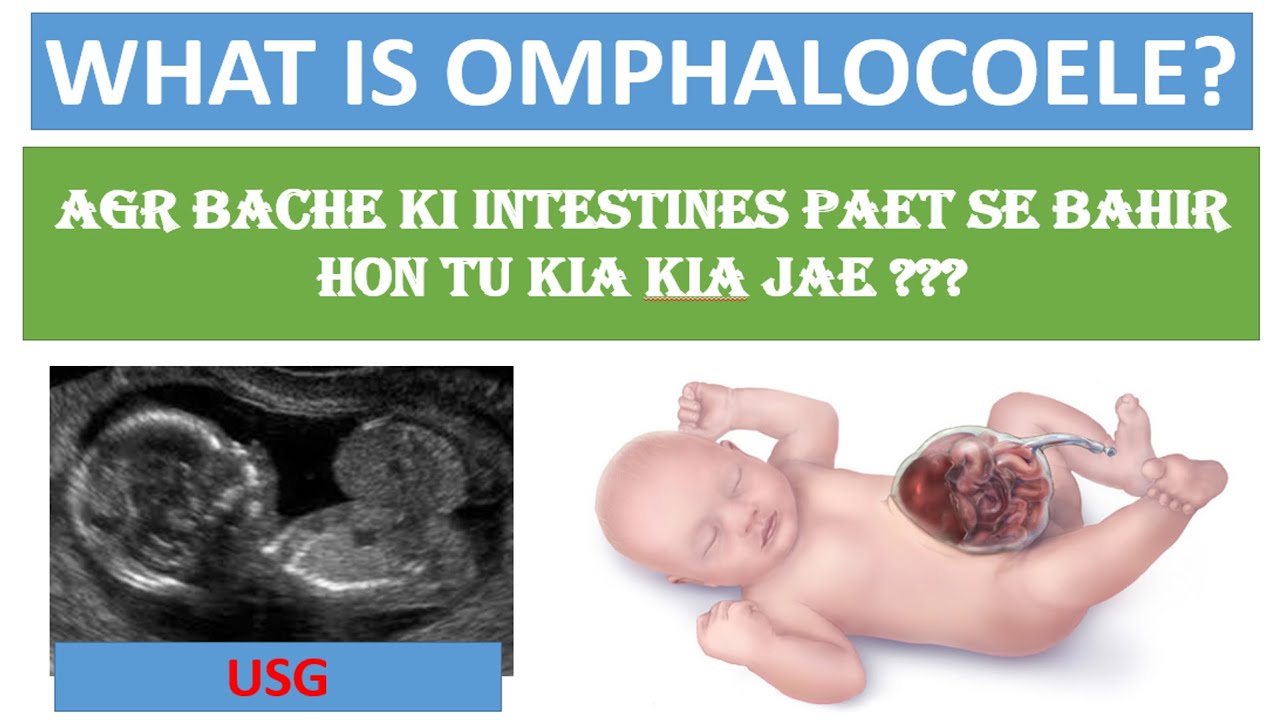 Delivery and treatment of babies with OMPHALOCELE | Monitoring baby ...
