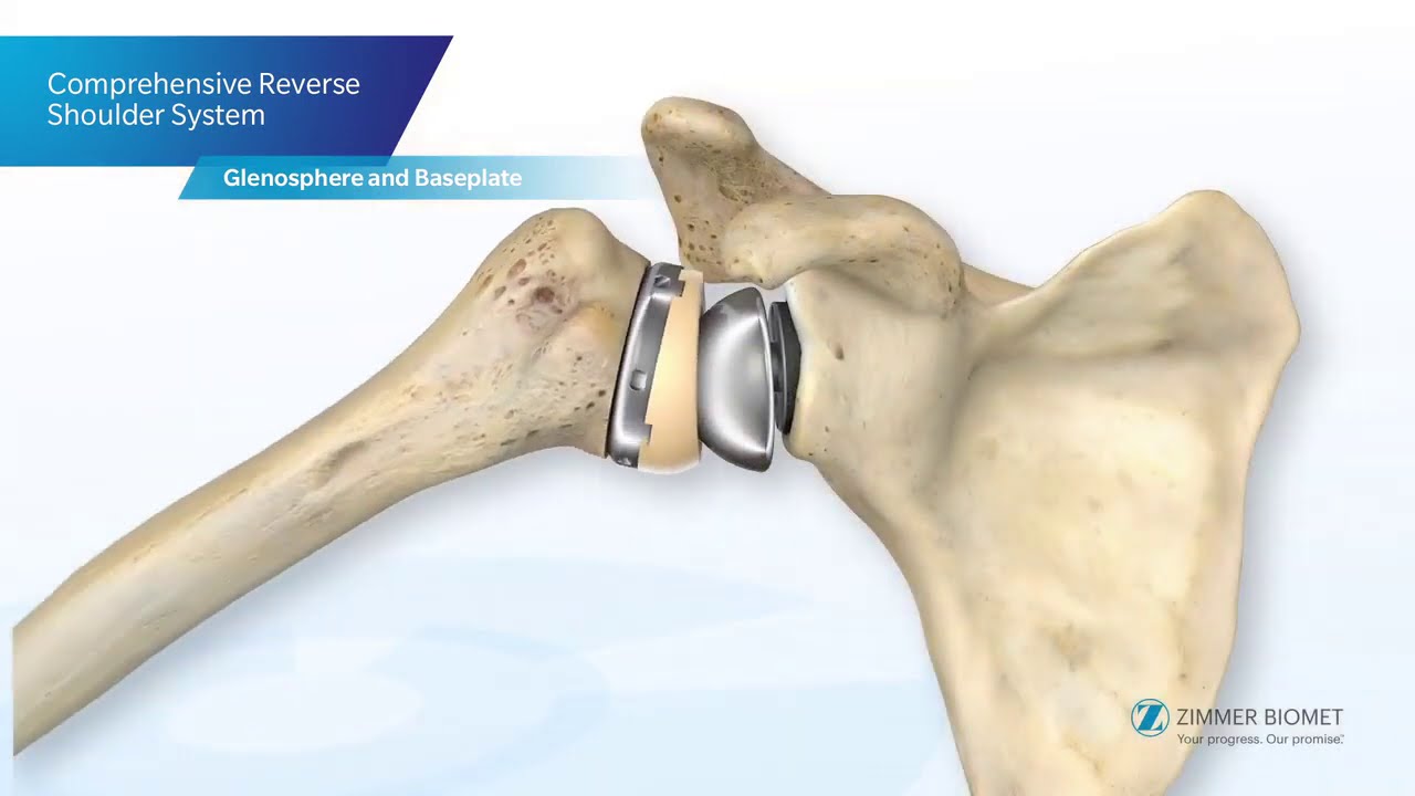 Comprehensive Humerus Reverse Part 2 | Dr. Ashutosh Ajri - YouTube